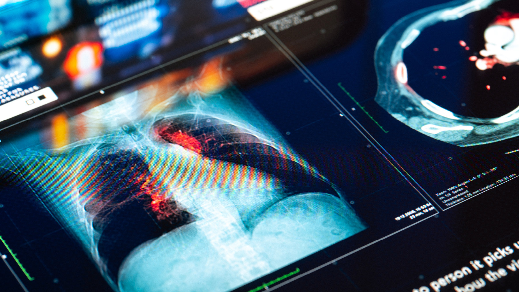 Early Lung Cancer Detection & More: It's Time for Action