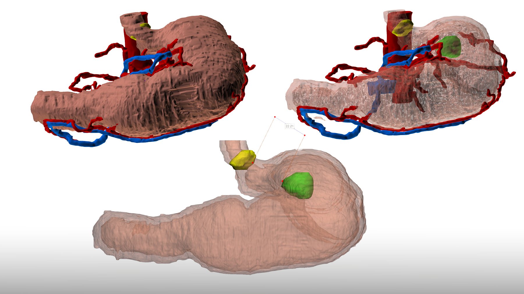 New Billing Code for 3D Anatomical Segmentation Imaging (C8001)