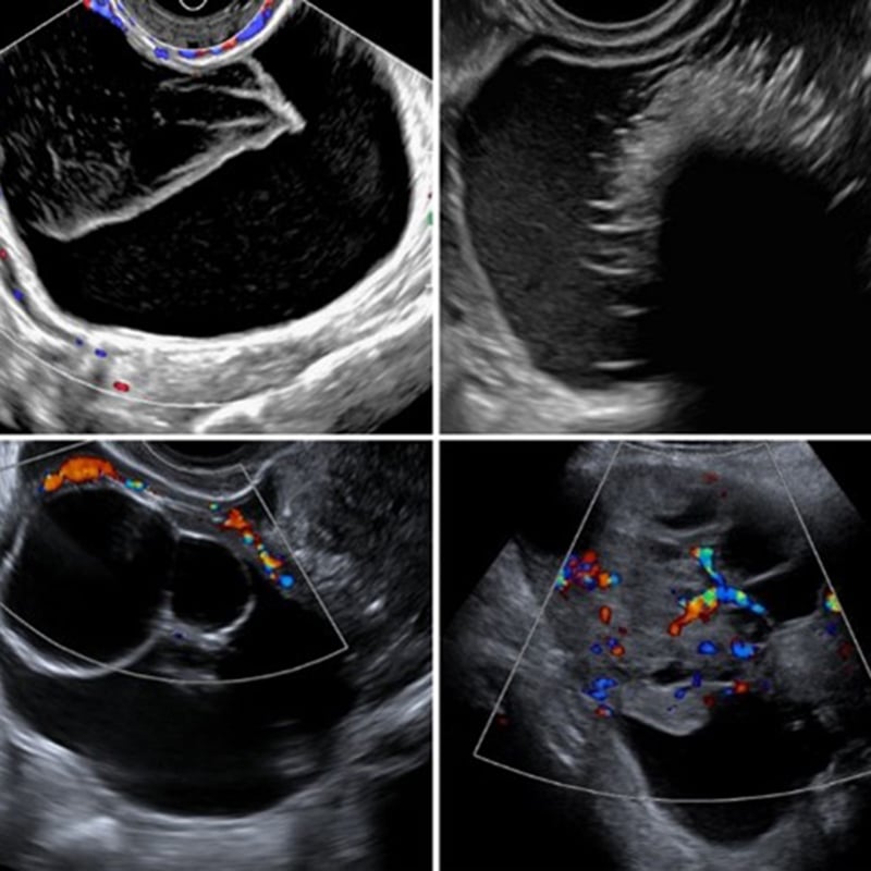 O-RADS™ Ultrasound