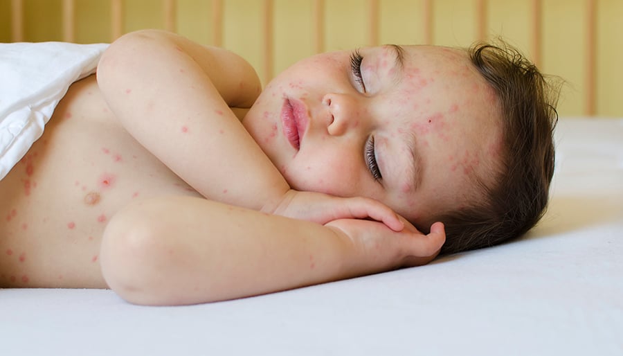 Monkeypox: What you need to know as a parent | Children's Wisconsin