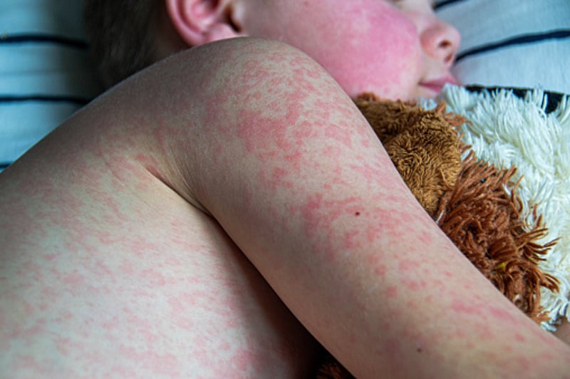 Measles Resources for Providers | Children's National Hospital