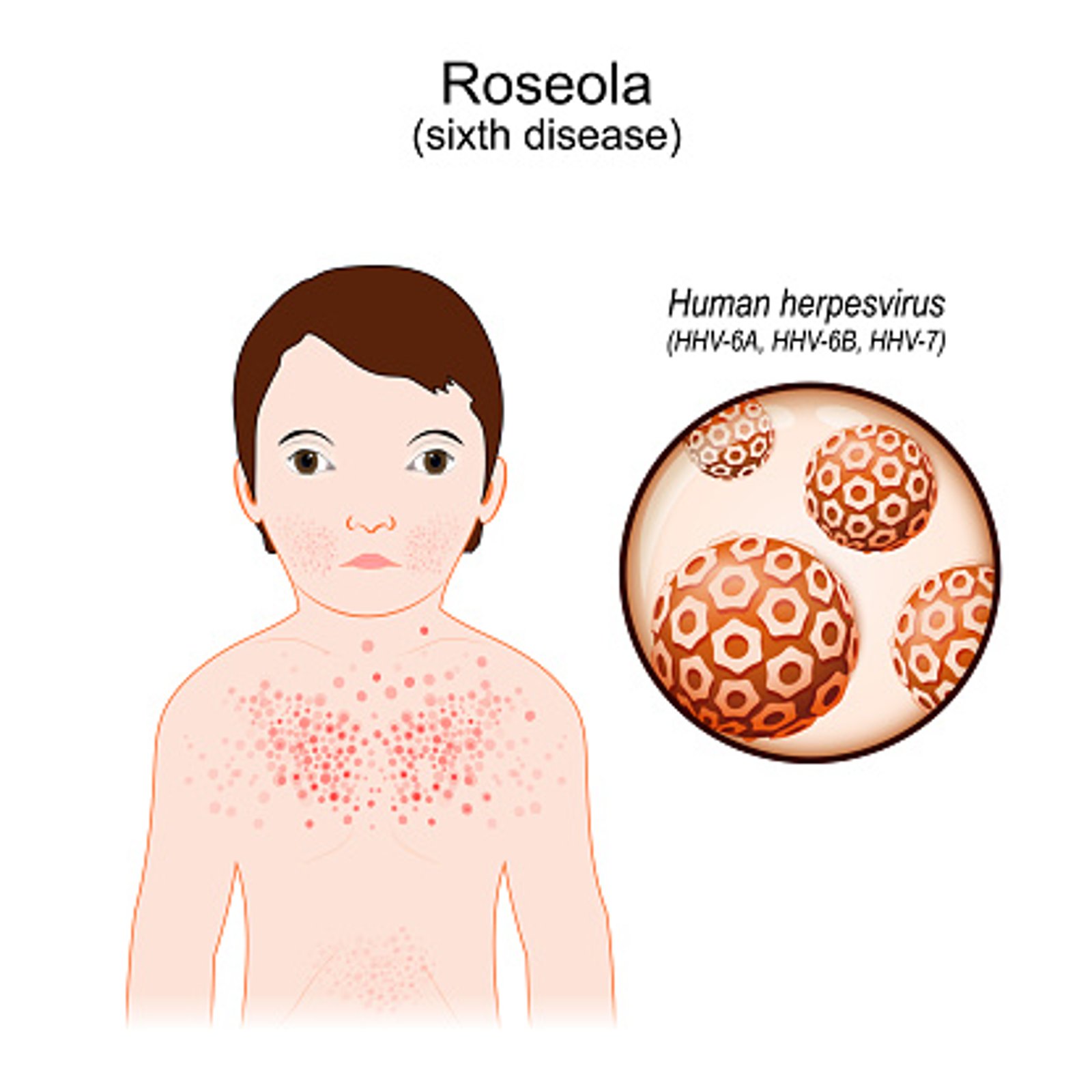 Viral Exanthems Rashes - Conditions and Treatments | Children's ...