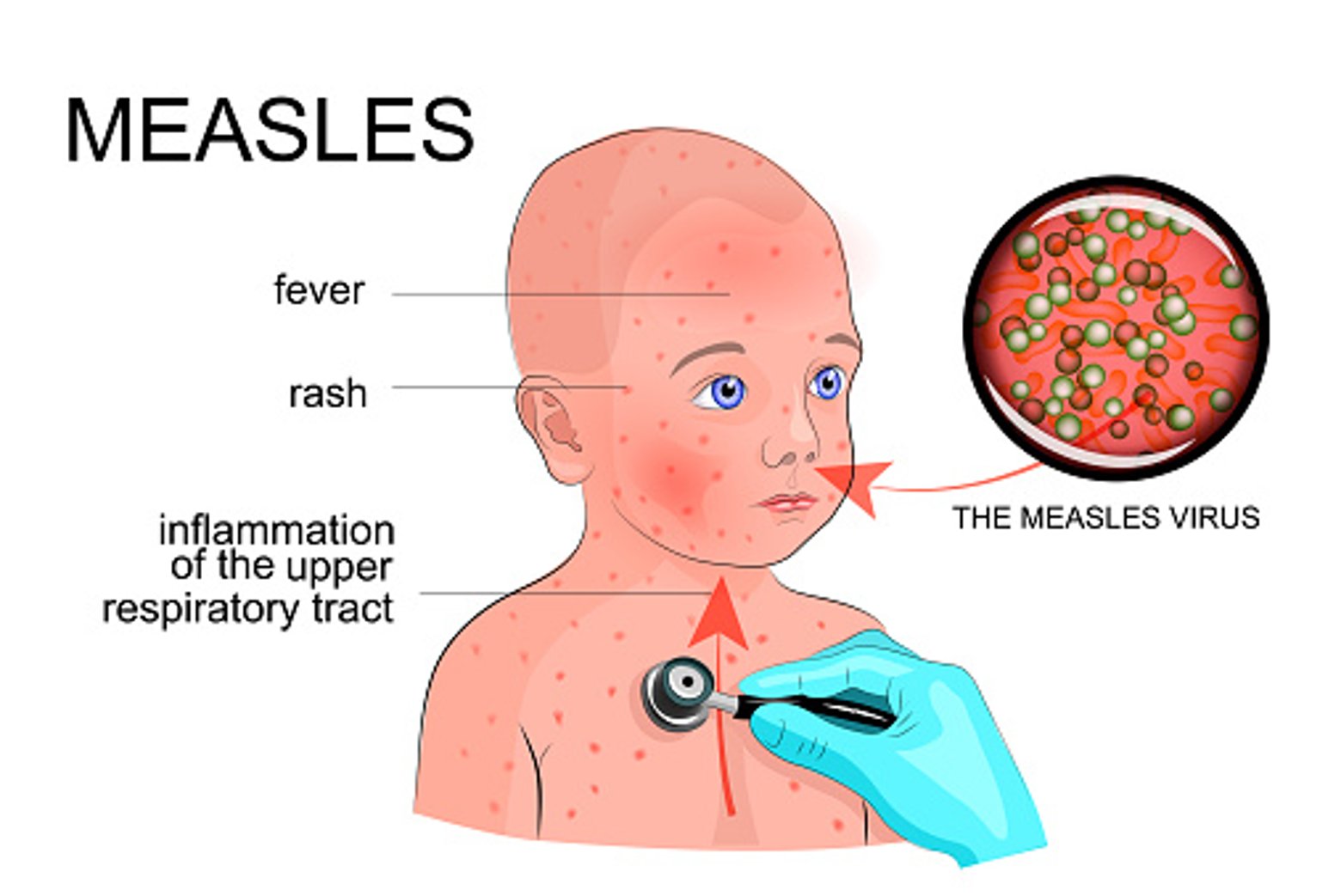 Viral Exanthems Rashes - Conditions and Treatments | Children's ...