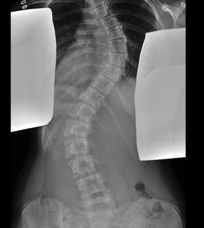 Posterior Spinal Fusion | Children's National Hospital