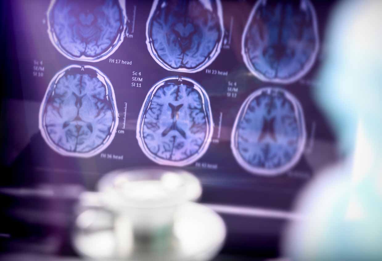 How Does the Brain Repair Itself after a Stroke?