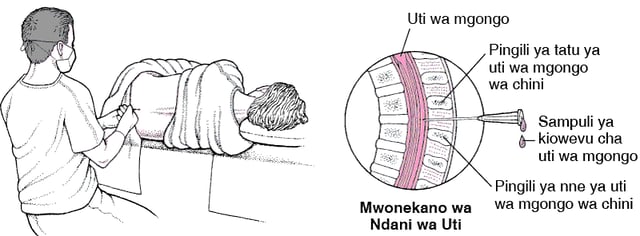 Vidokezo vya Haraka:Homa ya uti wa mgongo iliyosababishwa na bakteria ...