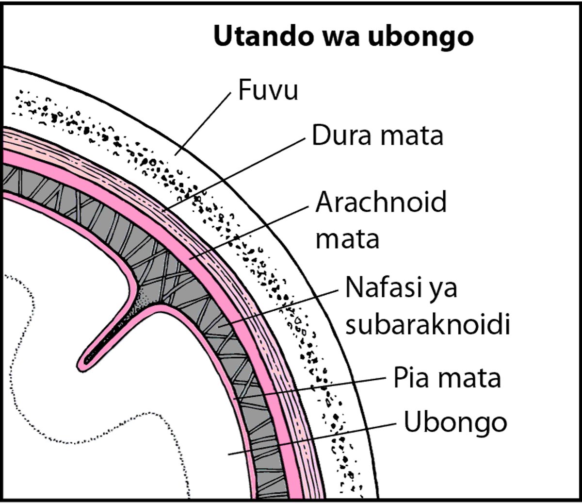Jipu la Epidural Intracranial na Subdural Empyema - Jipu la Epidural ...
