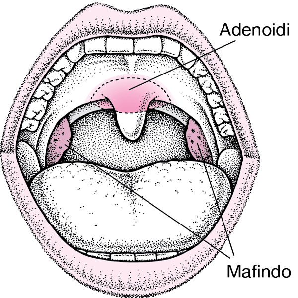 Matatizo ya Adenoidi - Matatizo ya Masikio, Pua na Koo - Toleo la Mtumiaji la Mwongozo wa MSD