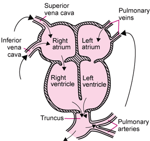 Truncus Arteriosus inayoendelea - Truncus Arteriosus inayoendelea ...
