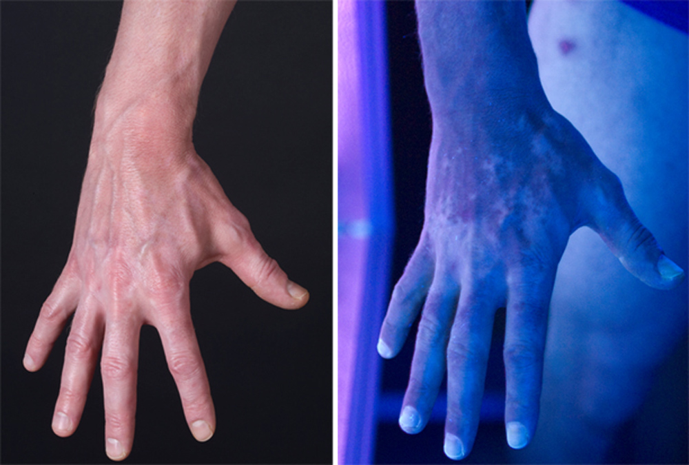 Diagnosis of Skin Disorders - Skin Disorders - MSD Manual Consumer Version