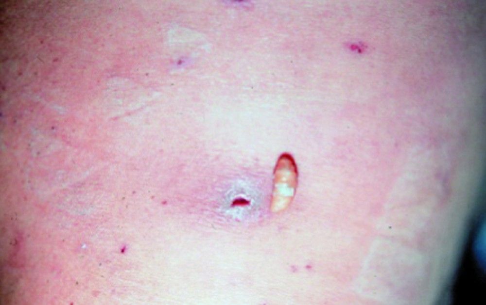 Cutaneous Myiasis - Skin Disorders - Merck Manual Consumer Version