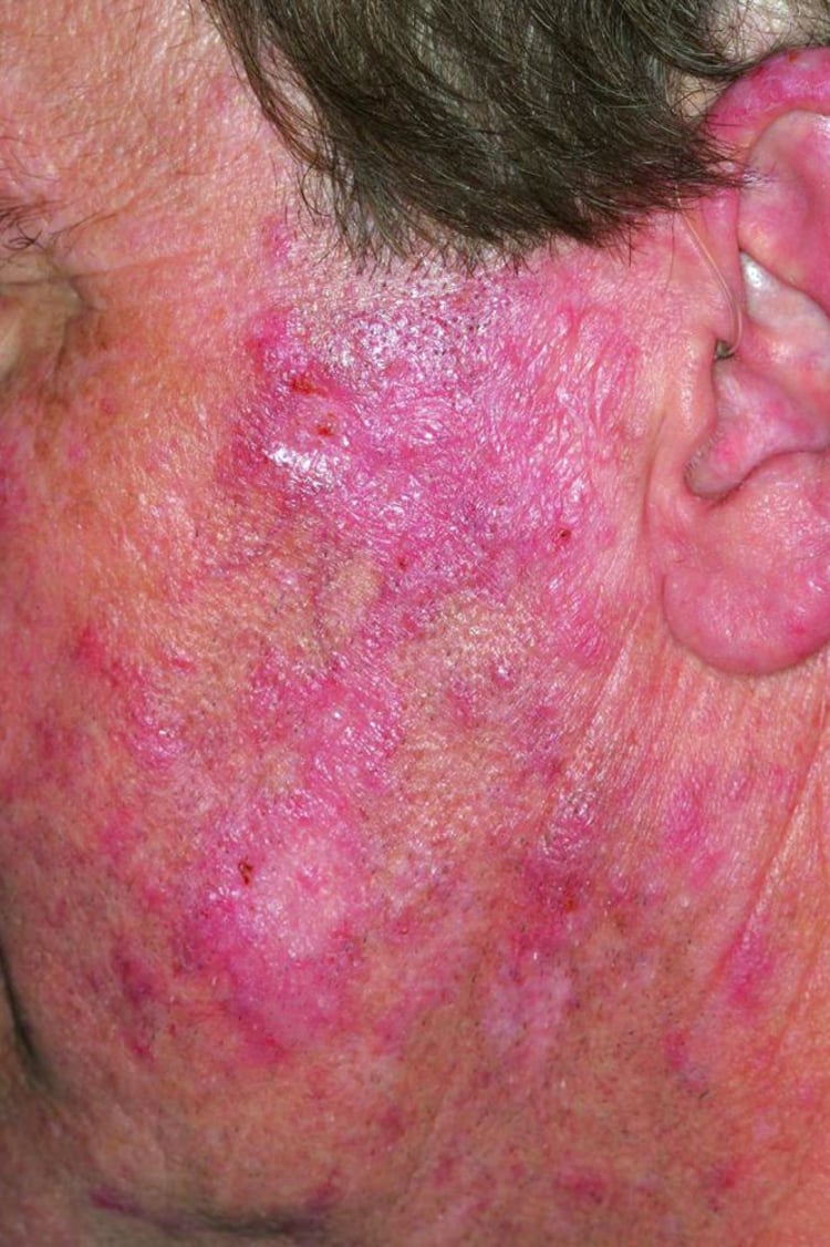 Lupus eritematoso sistémico (LES) - Trastornos de los huesos ...