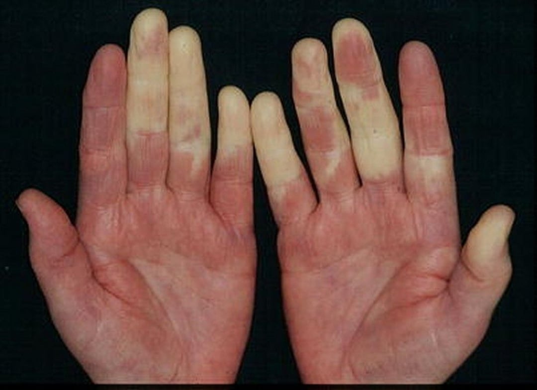 Systemic Lupus Erythematosus (SLE) - Bone, Joint, and Muscle Disorders ... Systemic Lupus Erythematosus (SLE) - Bone, Joint, and Muscle Disorders ...