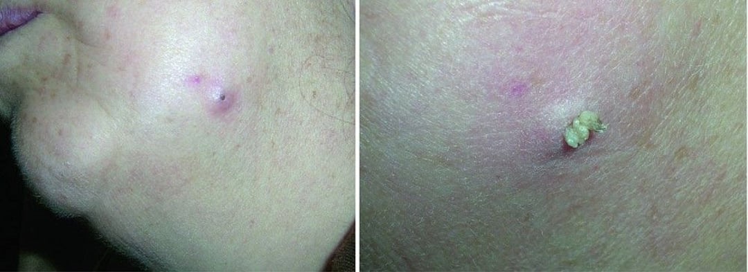 Quick Facts:Skin Cysts - Merck Manual Consumer Version