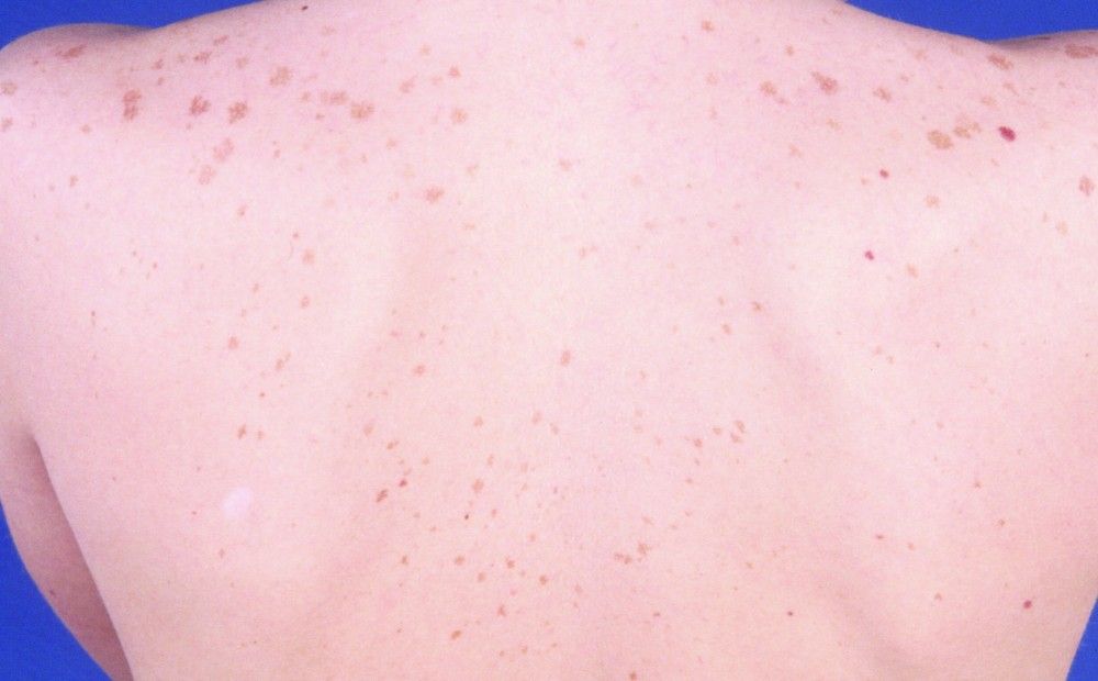 Hyperpigmentation - Skin Disorders - MSD Manual Consumer Version