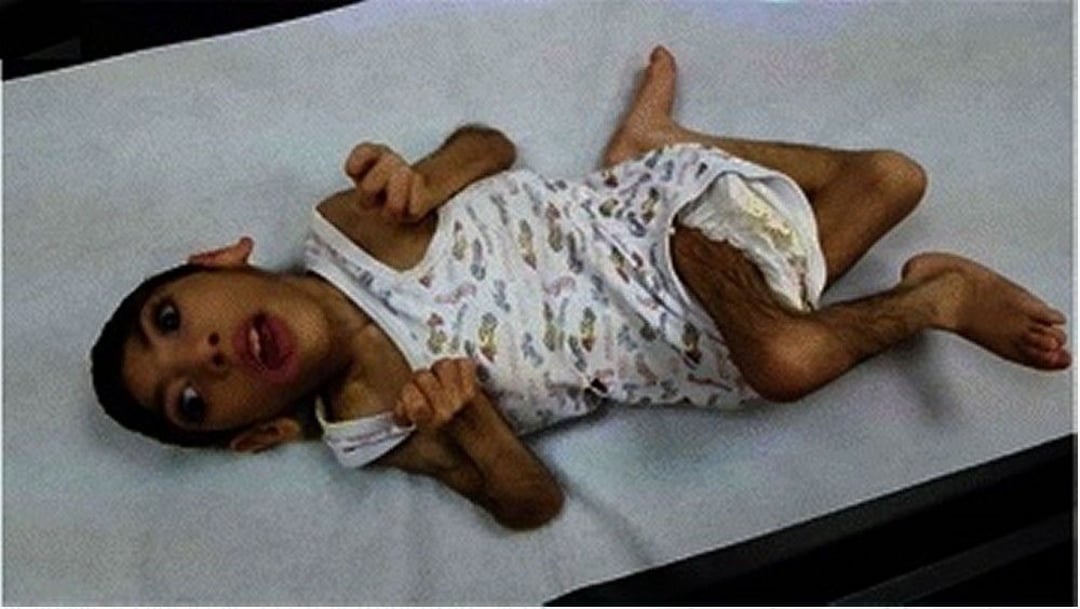 Microcephaly - Microcephaly - Merck Manual Consumer Version