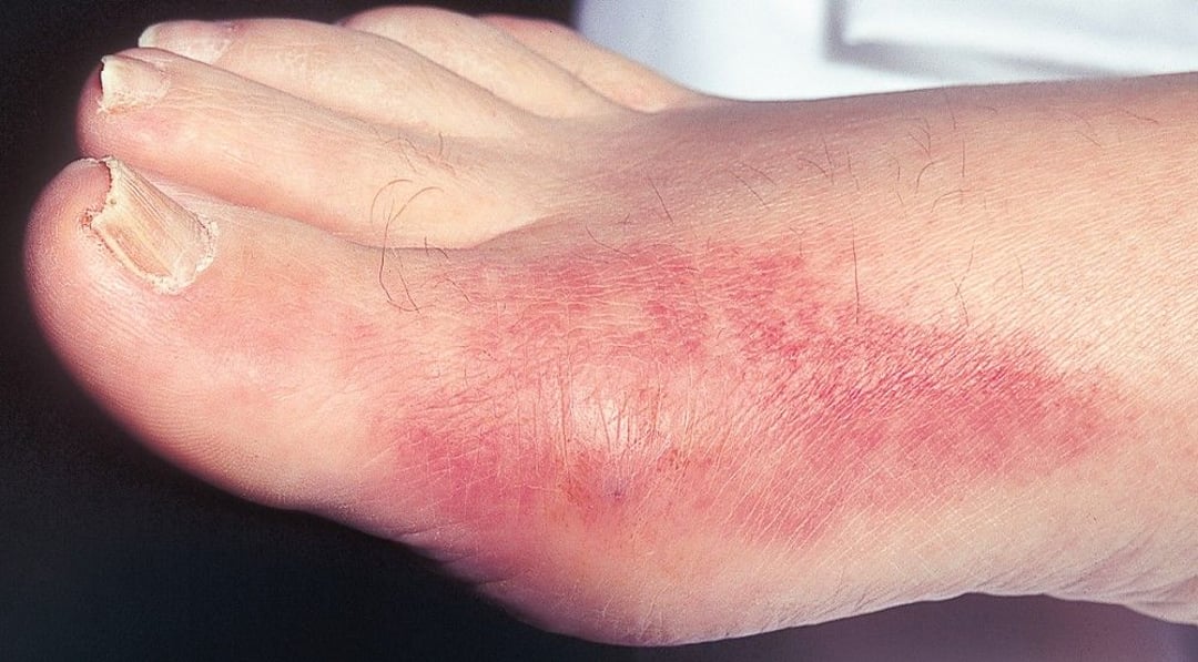 Gout - Bone, Joint, and Muscle Disorders - Merck Manual Consumer Version