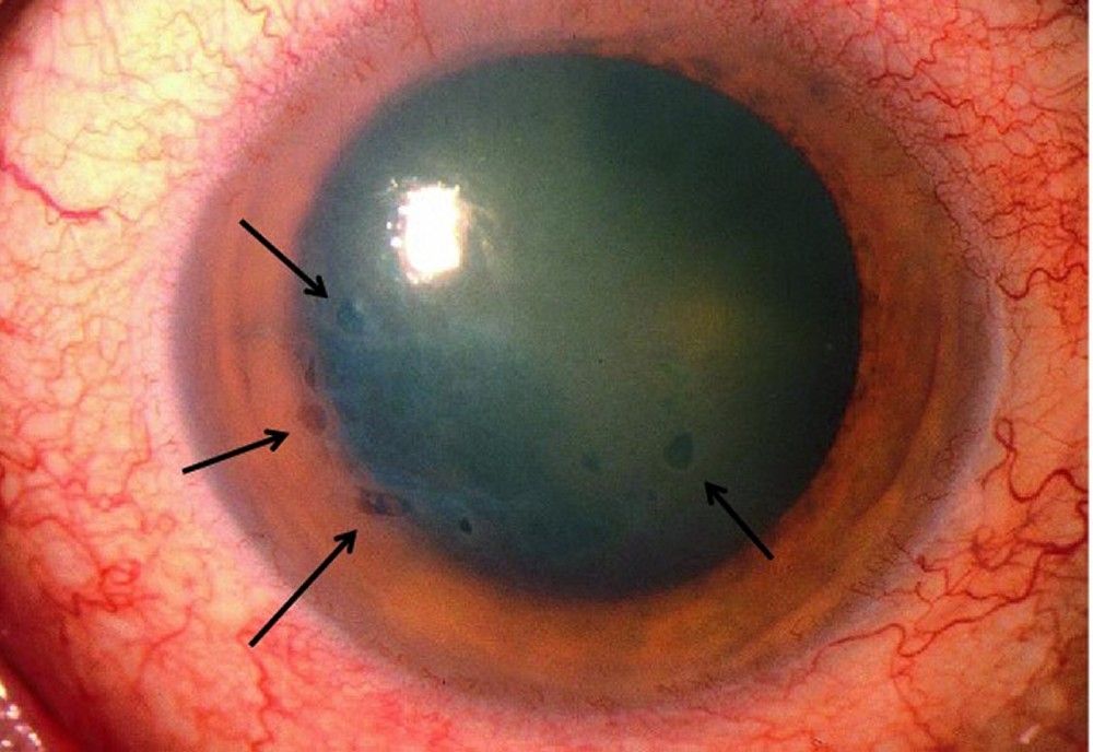 Bullous Keratopathy - Eye Disorders - Merck Manual Consumer Version