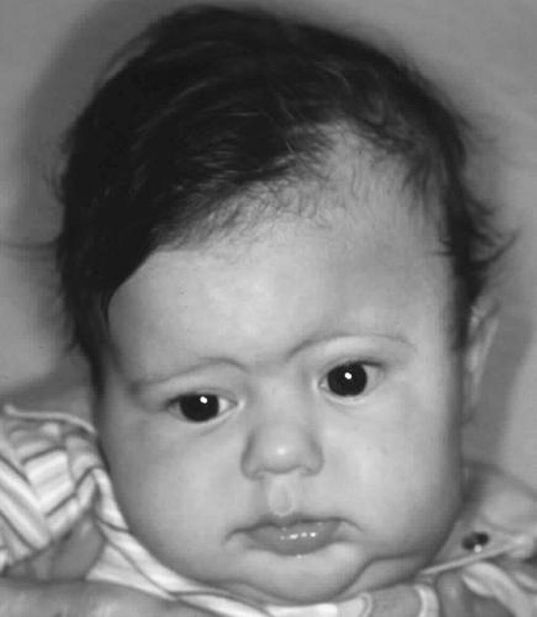 Image:Craniosynostose de la suture coronale gauche (craniosynostose ...