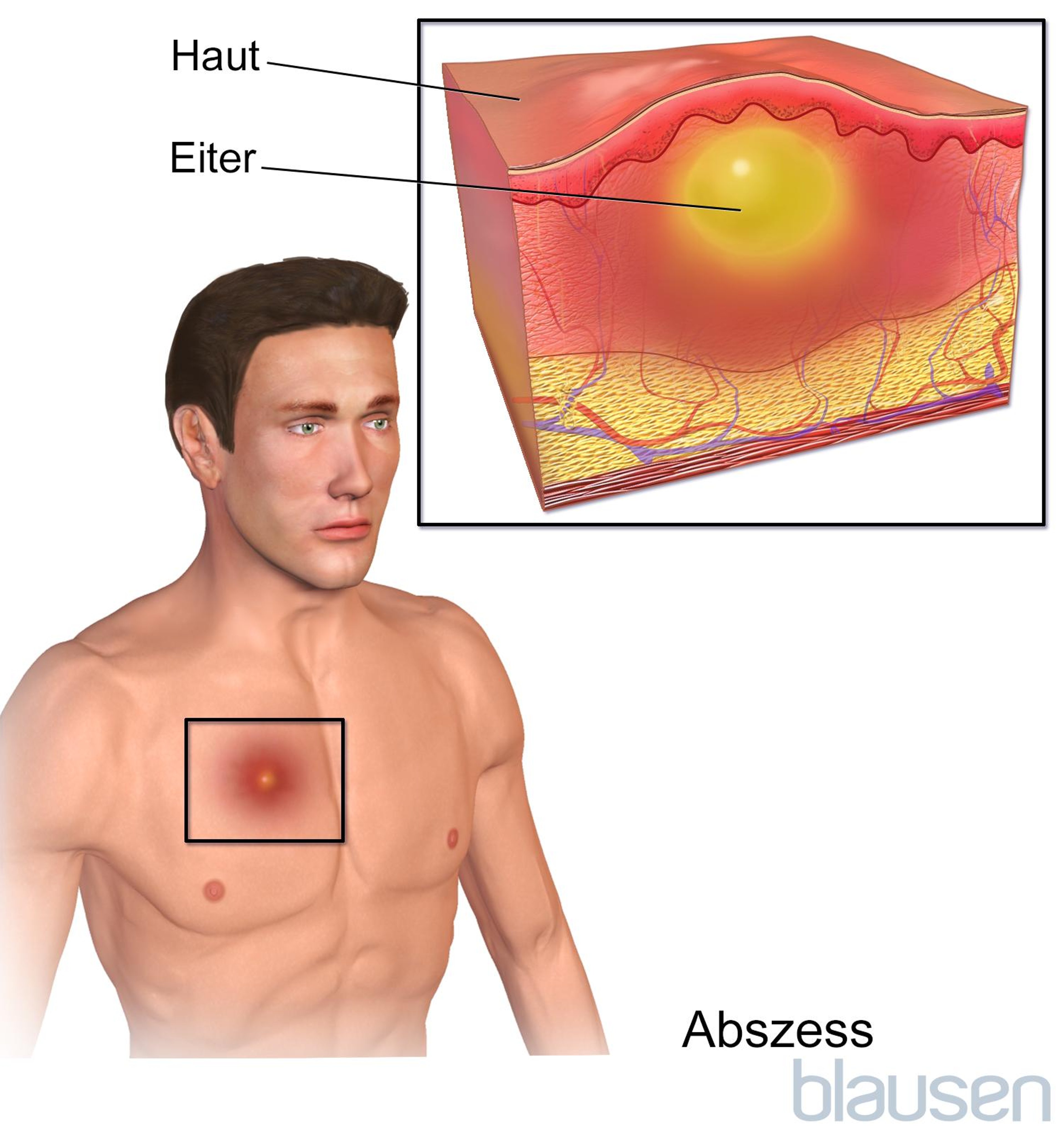 Image:Hautabszess-MSD Manual Ausgabe für Patienten