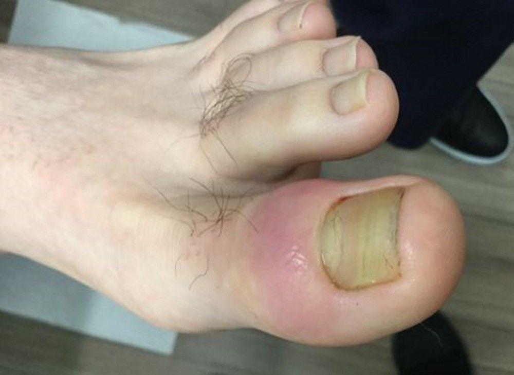 Retronychia - Skin Disorders - MSD Manual Consumer Version