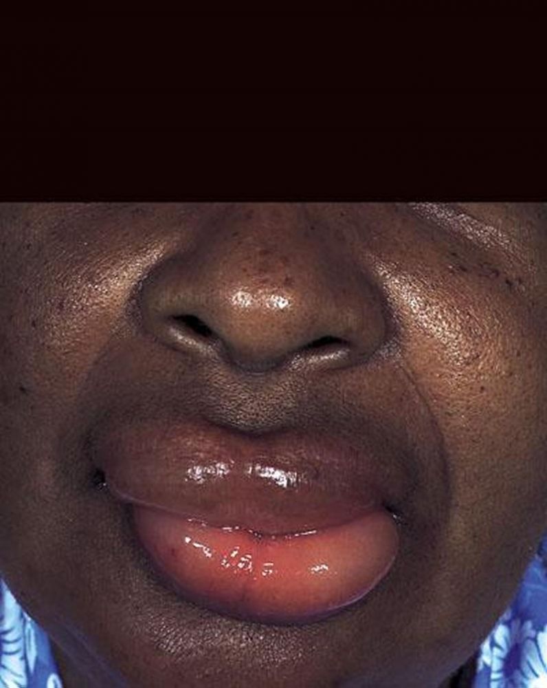 Angioedema - Trastornos inmunológicos - Manuale Merck versión para el ...