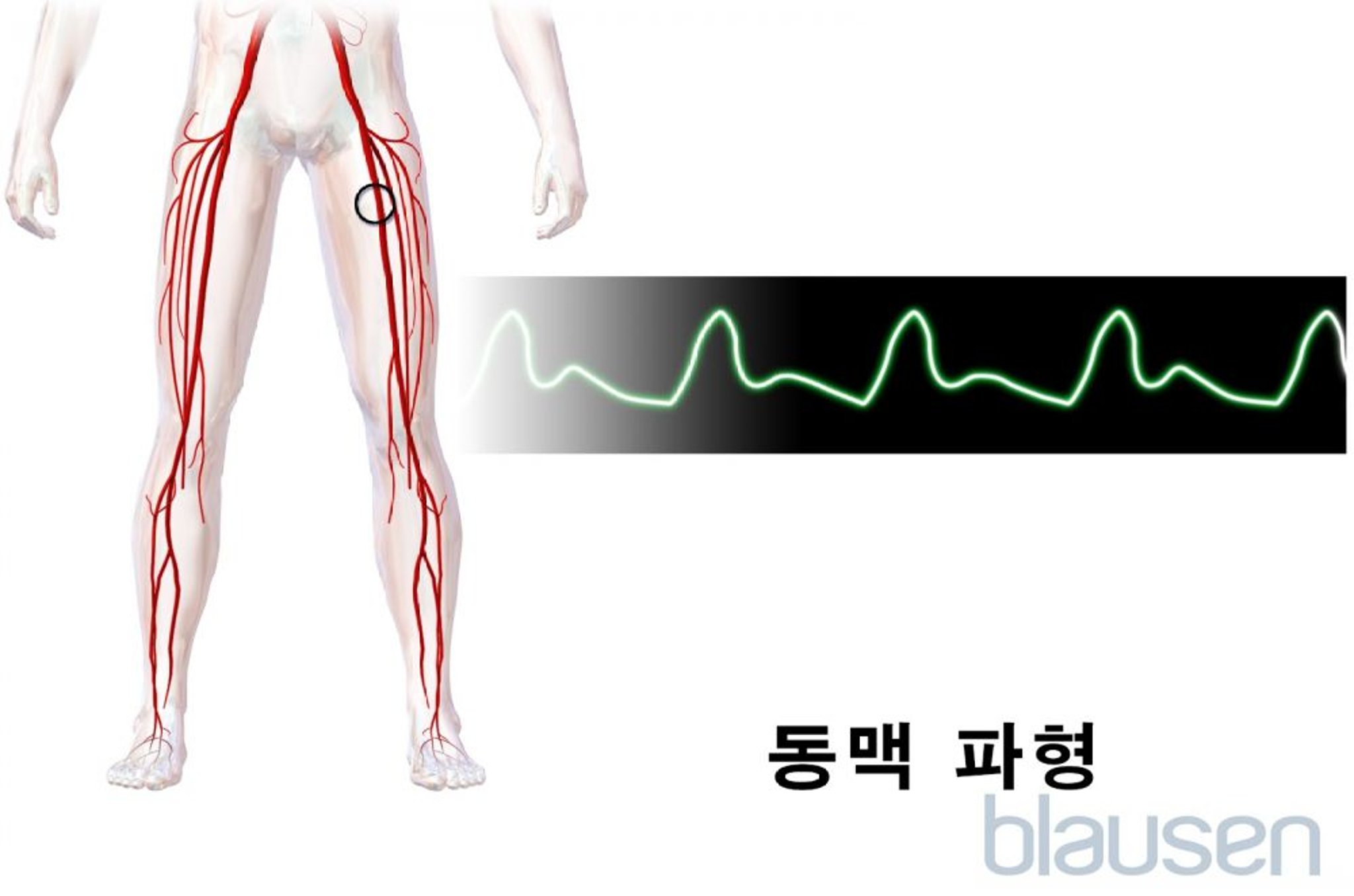 폐쇄성 말초 동맥 질환 심장 및 혈관 장애 Msd 매뉴얼 일반인용