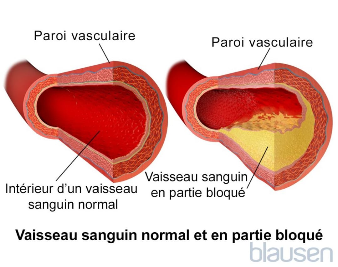Athérosclérose - Athérosclérose - Manuels Merck pour le grand public