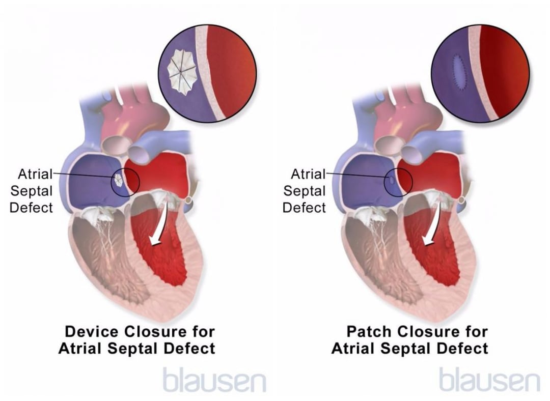 Defectos en el tabique auricular y ventricular - Defectos en el tabique ...