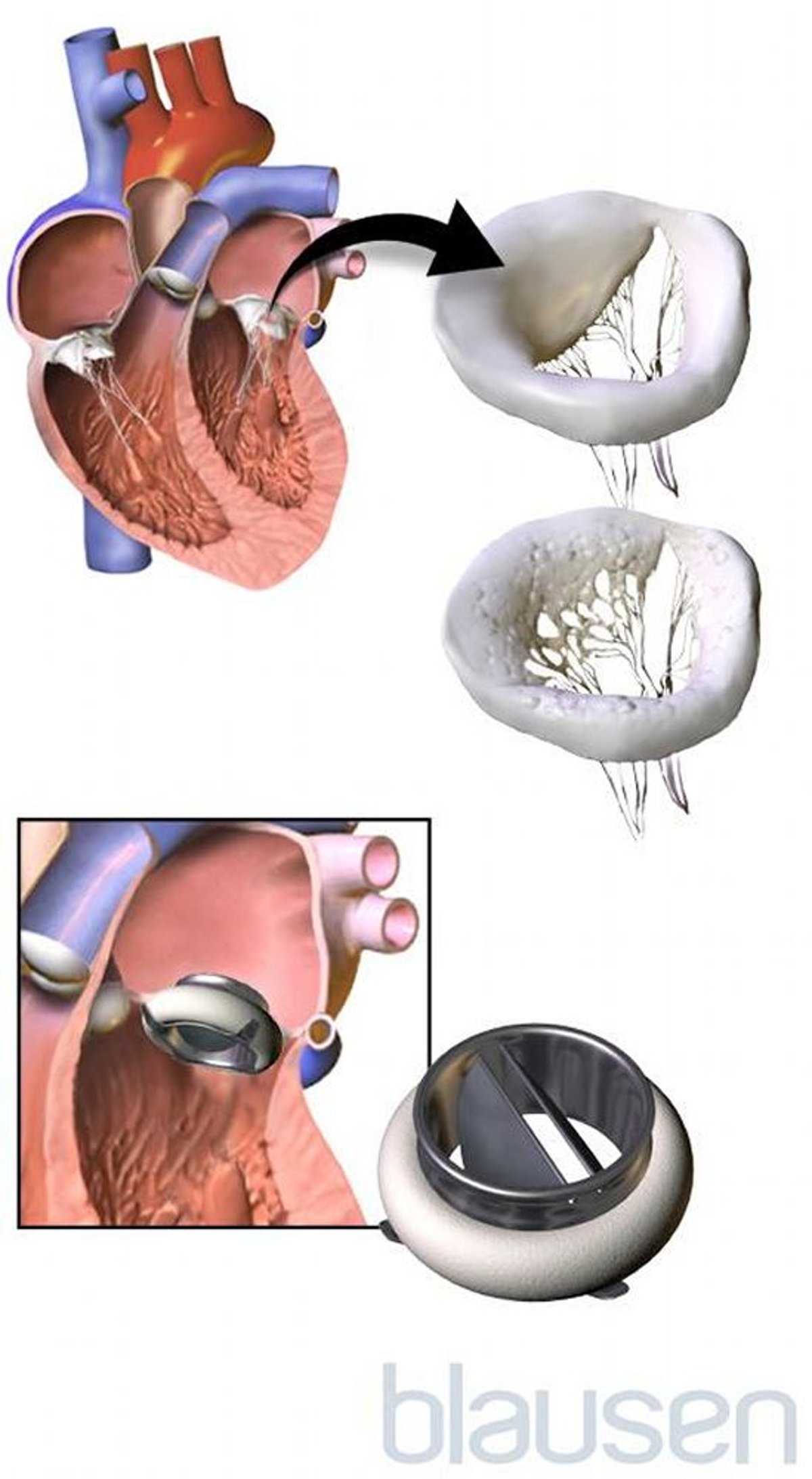 Image:Valvola cardiaca artificiale-Manuale MSD, versione per i pazienti