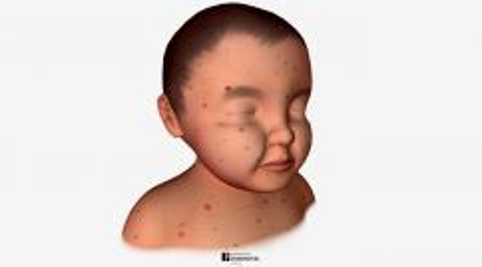 3D Model: Chickenpox-Merck Manual Consumer Version
