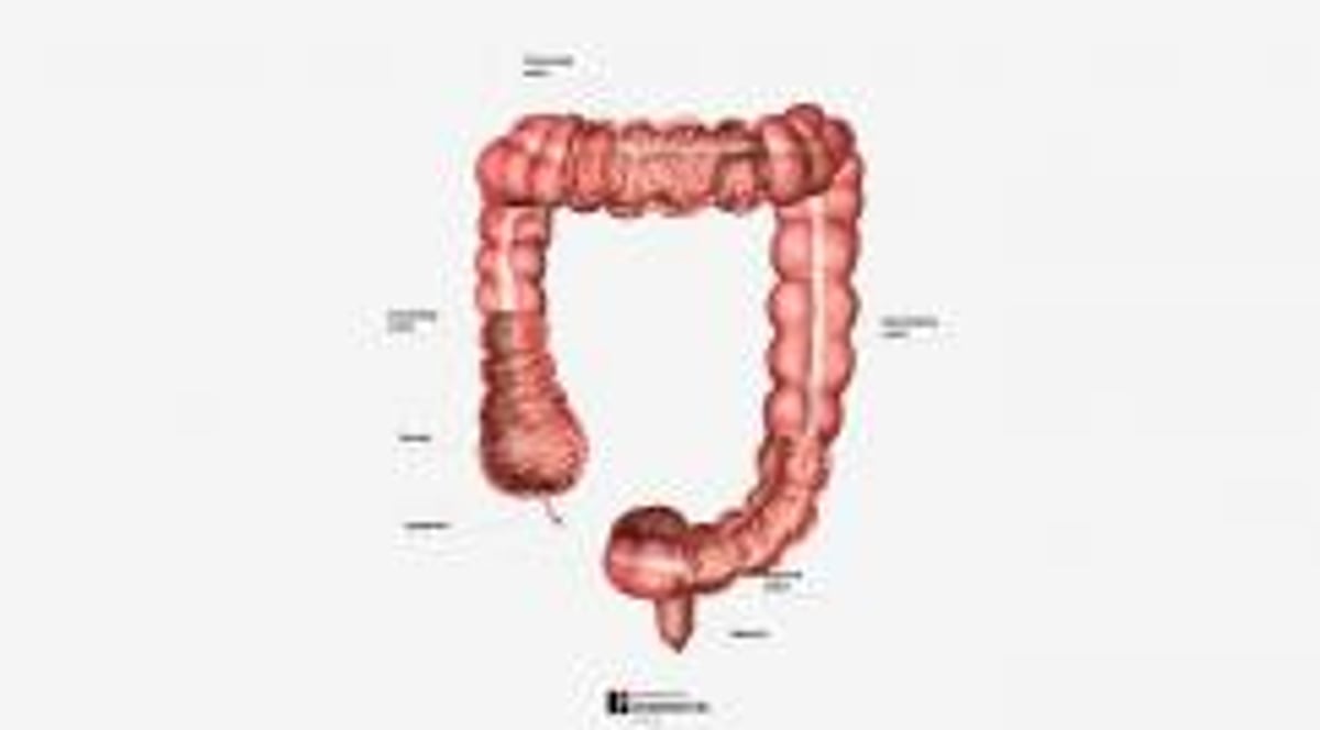 Diverticulosis of the Large Intestine - Digestive Disorders - Merck ...