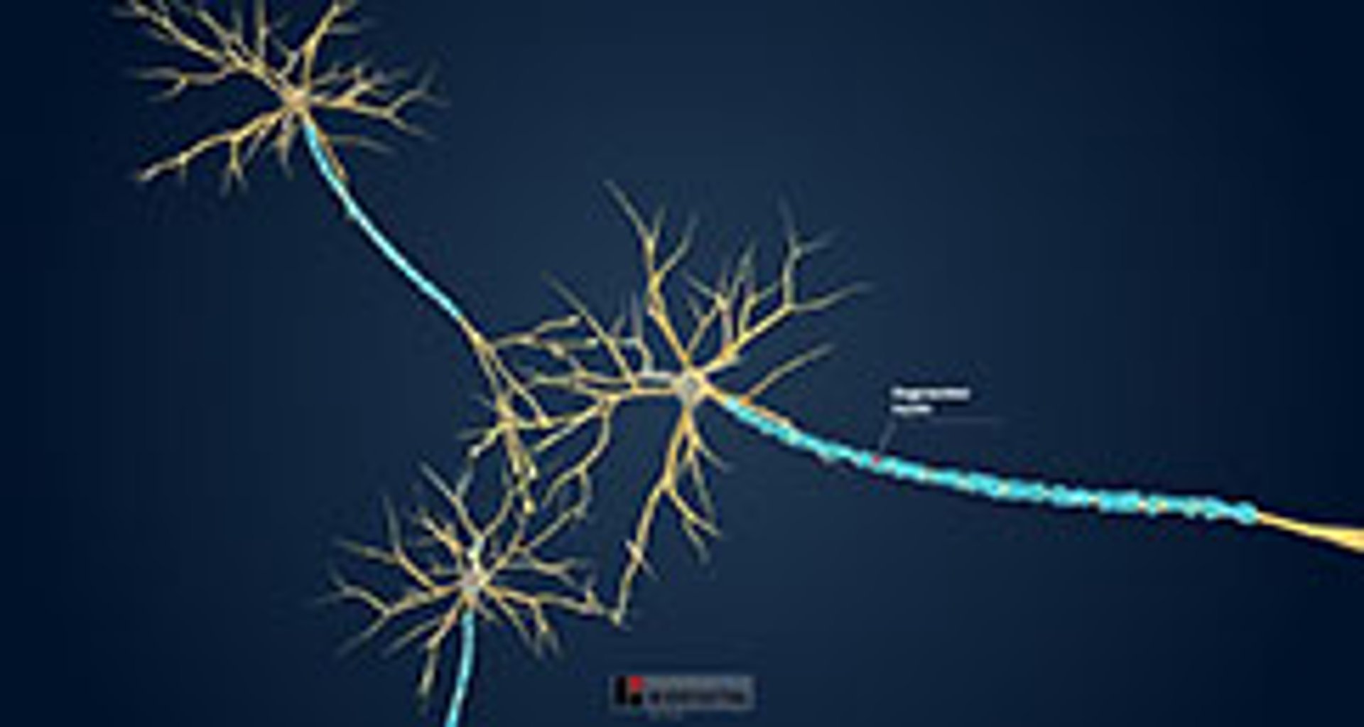 3D Model: Multiple Sclerosis: Neurons with Degenerated Myelin-MSD ...