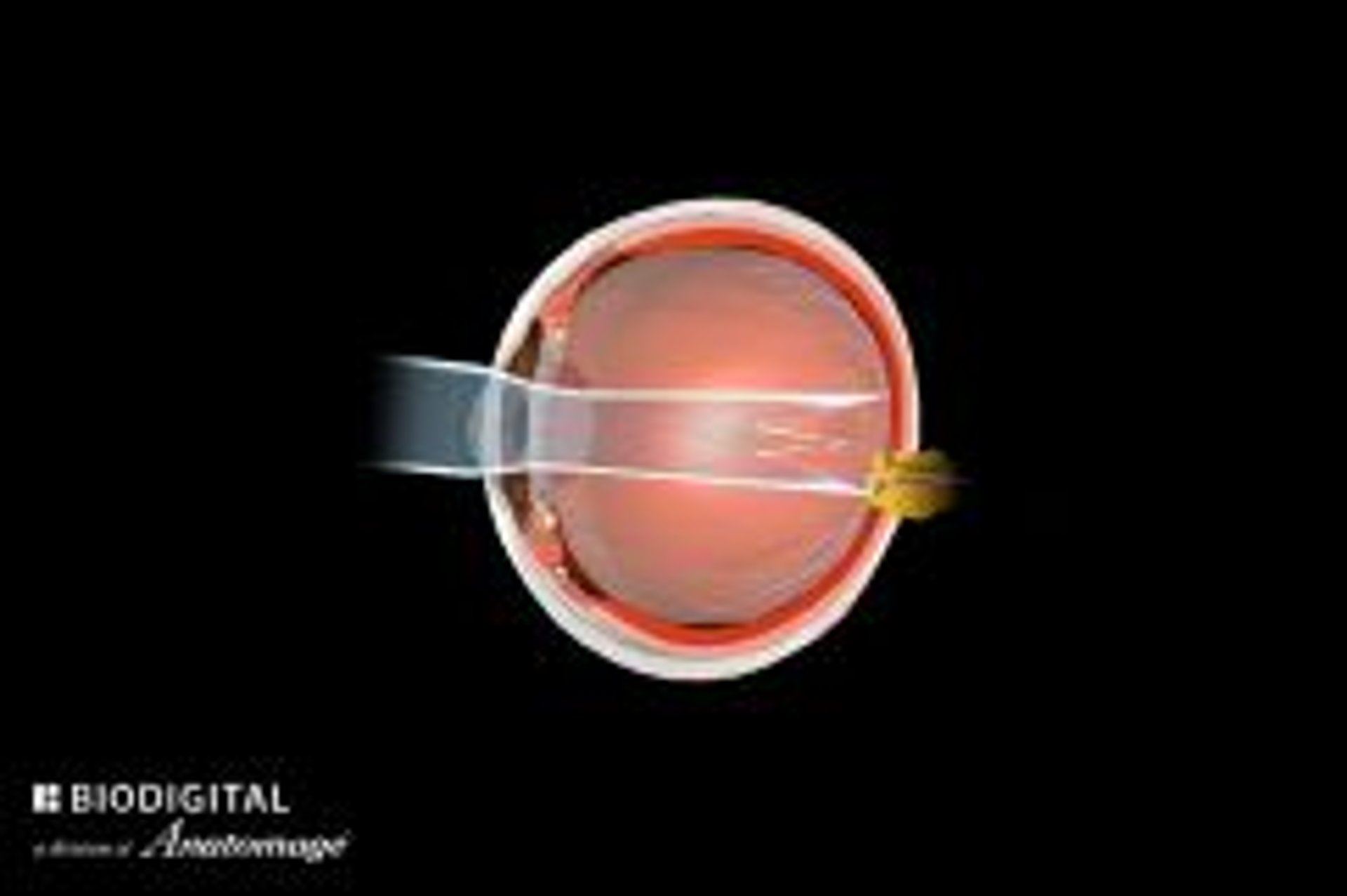 3D Model: Astigmatism-MSD Manual Consumer Version