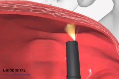 Cystoscopy - Urinary Tract Disorders - MSD Manual Consumer Version