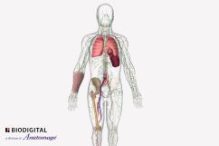 Chronic Myeloid Leukemia (CML) - Cancer - Merck Manual Consumer Version