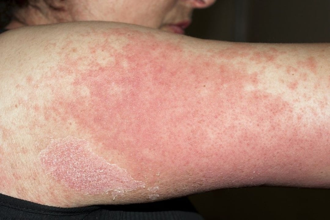 Image:Rash Caused by a Medication Reaction-Merck Manual Consumer Version
