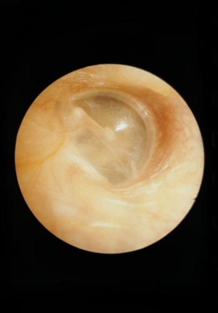 Eardrum Perforation - Ear, Nose, and Throat Disorders - MSD Manual ...