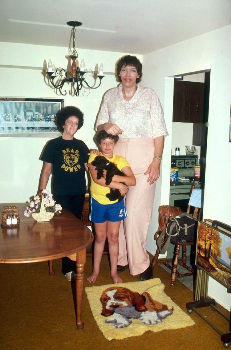 Quick Facts:Gigantism and Acromegaly - MSD Manual Consumer Version