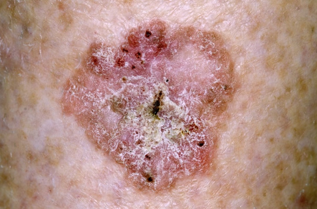 Squamous Cell Carcinoma in Situ - Skin Disorders - Merck Manual ...