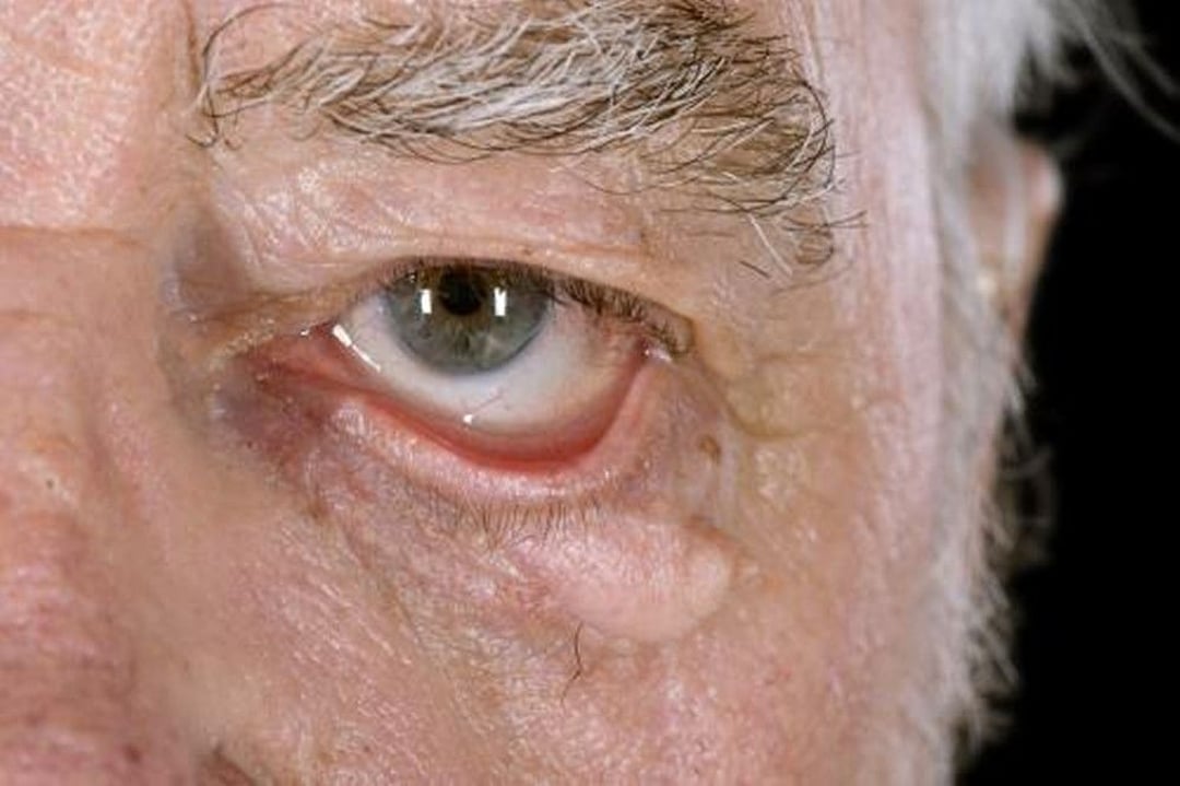 Entropion and Ectropion - Eye Disorders - Merck Manual Consumer Version