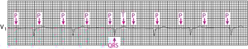 Image:Bloc atrioventriculaire du troisième degré-Manuels MSD pour le ...