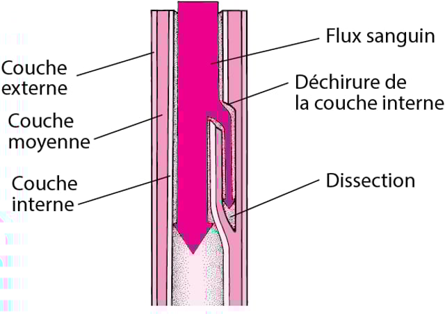 Image:Comprendre la dissection aortique-Manuels Merck pour le grand public