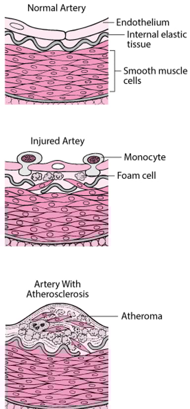 Atherosclerosis - Heart and Blood Vessel Disorders - MSD Manual ...