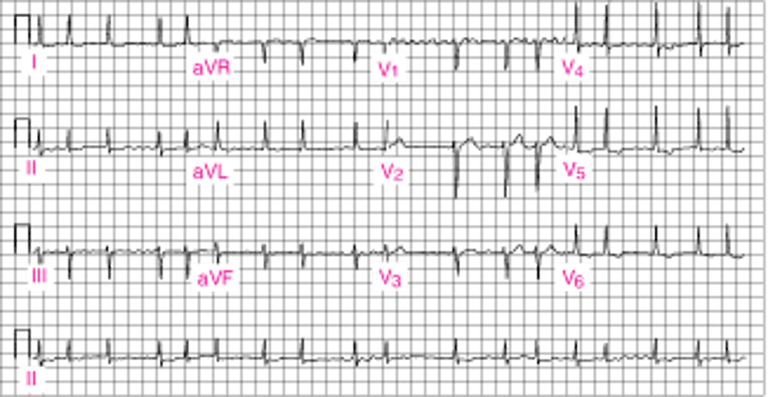 Atrial Fibrilasi dan Atrial Flutter - Gangguan Jantung dan Pembuluh ...