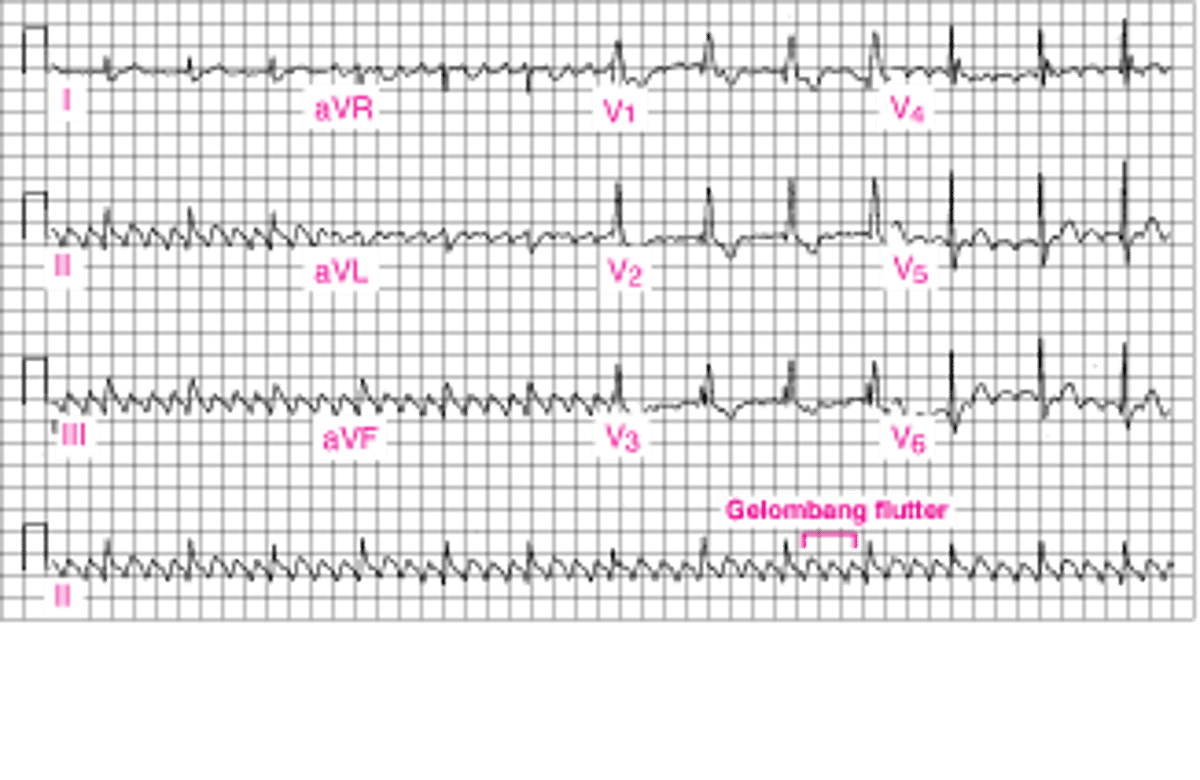 Atrial Fibrilasi dan Atrial Flutter - Gangguan Jantung dan Pembuluh ...