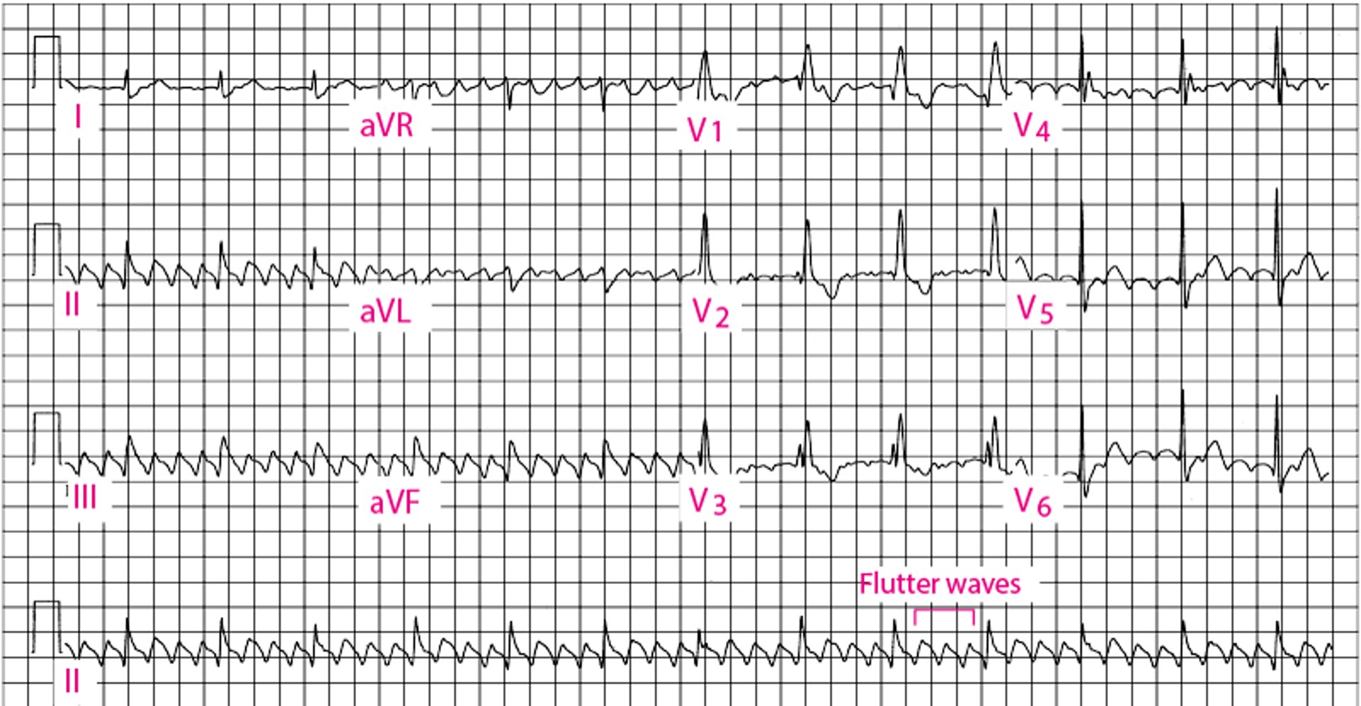 Image:Vorhofflattern-MSD Manual Profi-Ausgabe