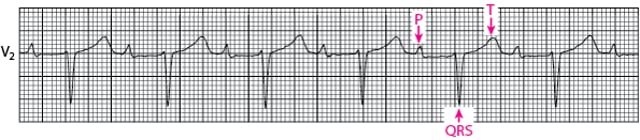 Atrioventricular Block - Heart and Blood Vessel Disorders - MSD Manual ...