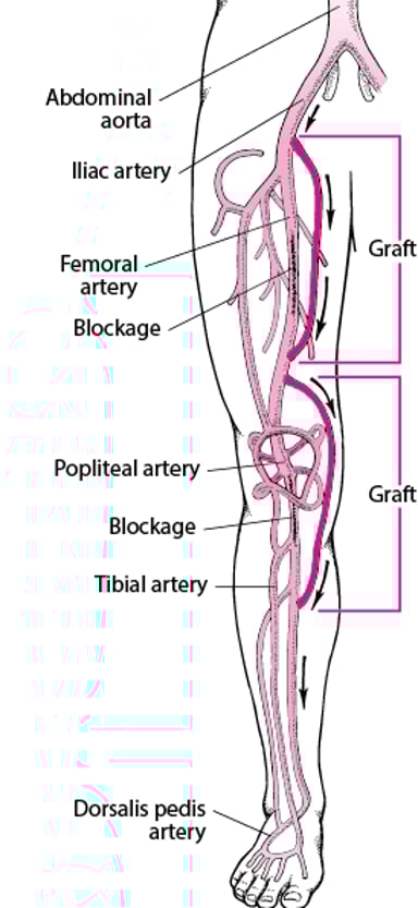 Imagebypass Surgery In The Leg Merck Manual Consumer Version
