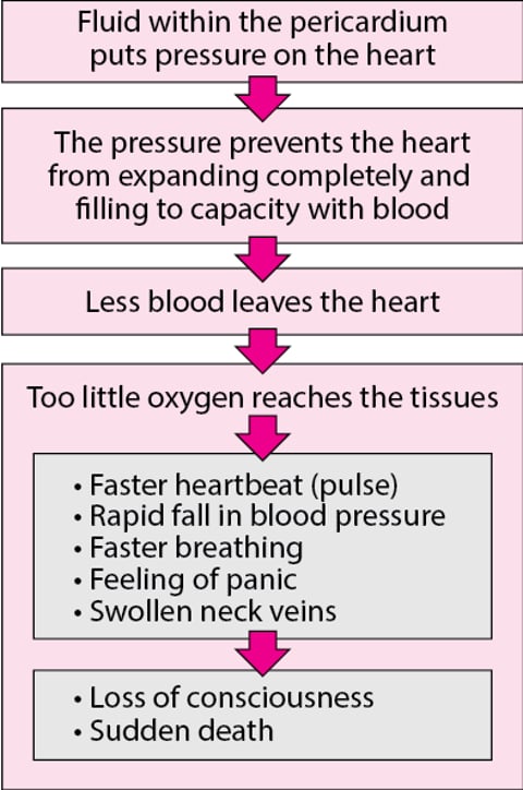 Cardiac Tamponade - Injuries and Poisoning - MSD Manual Consumer Version